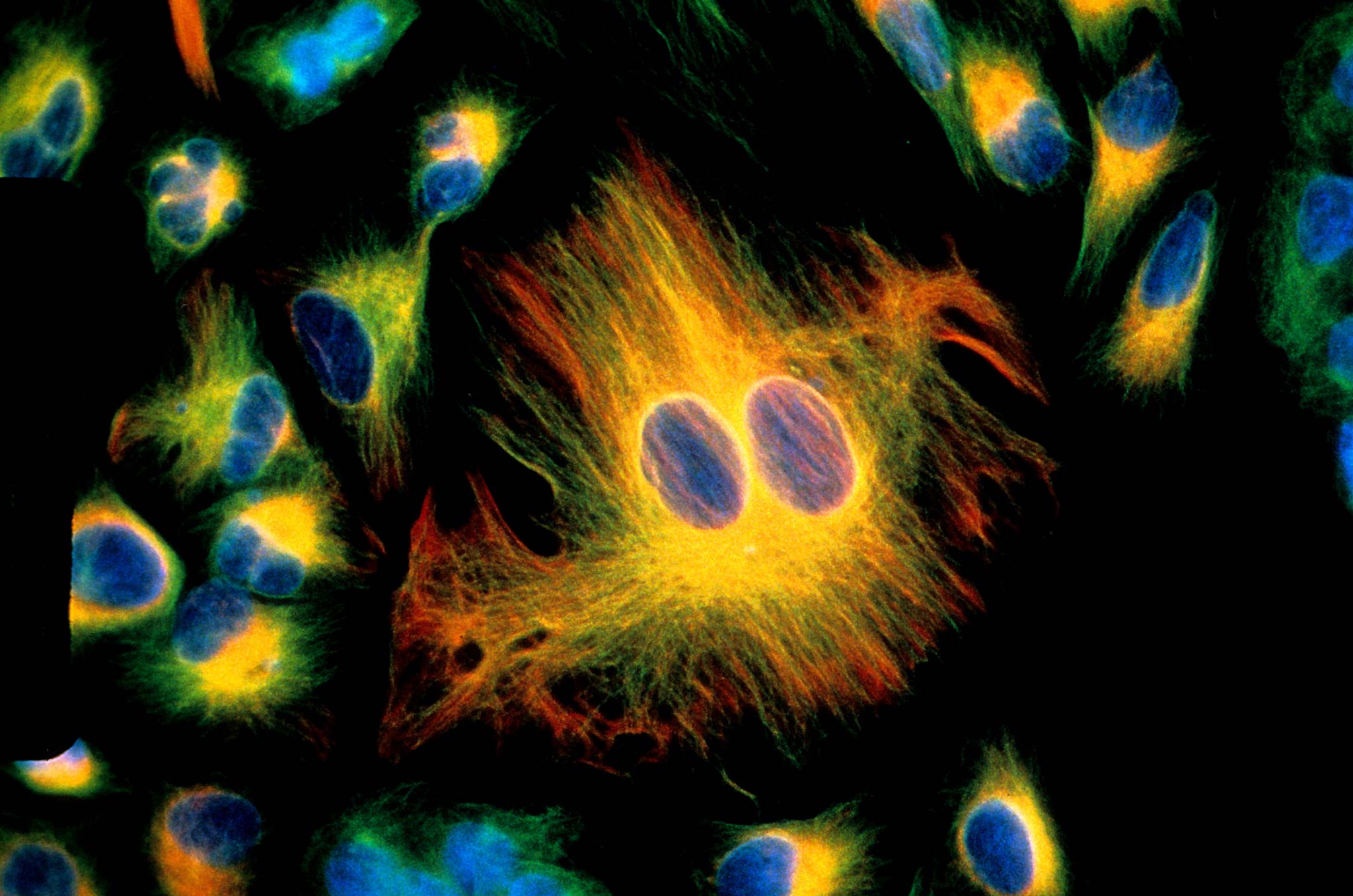 Triple exposure of melanoma and carcinoma cell culture | Nikon Small World