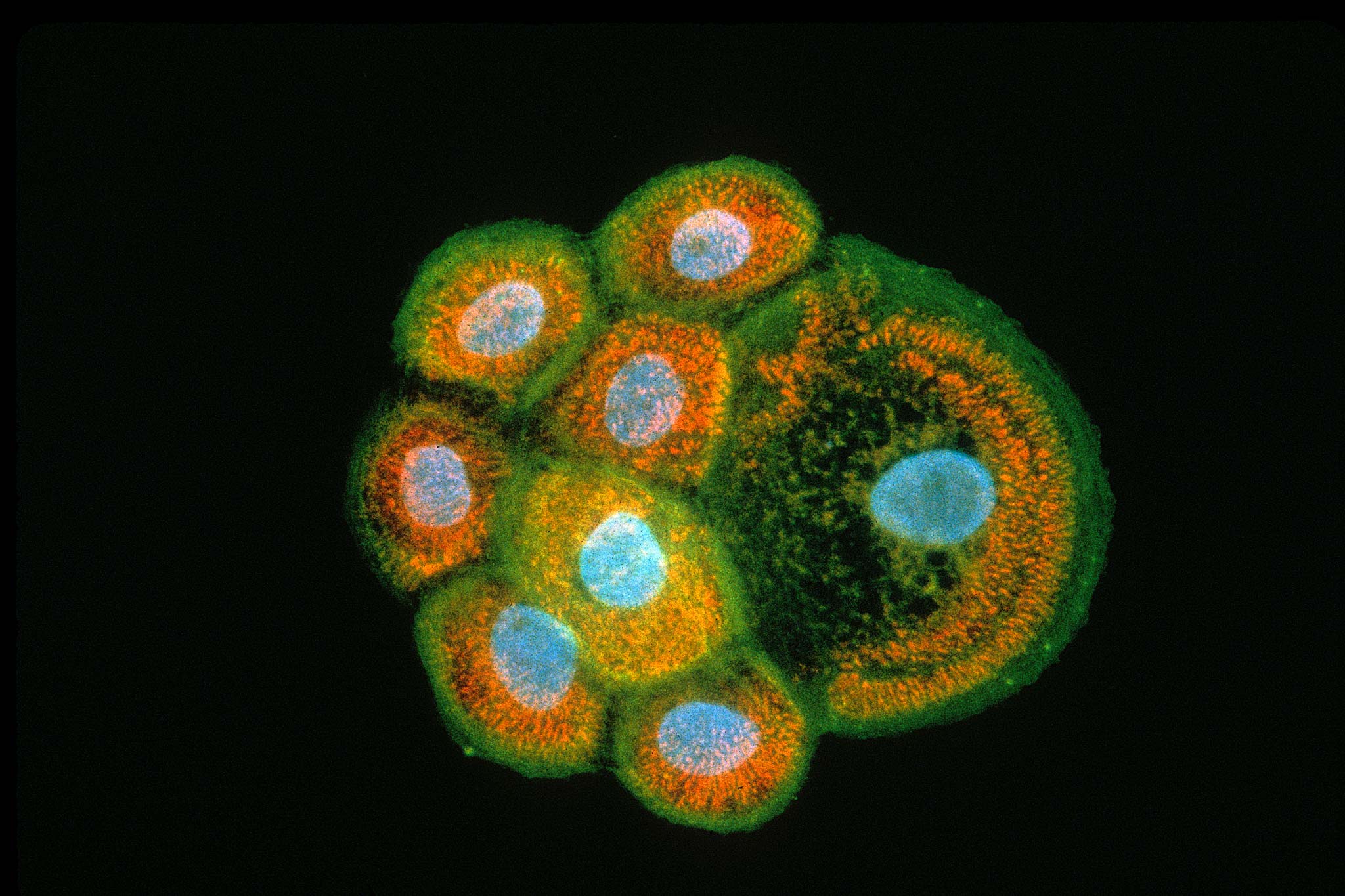 Triple exposure of human squamous skin cancer cell culture | Nikon ...