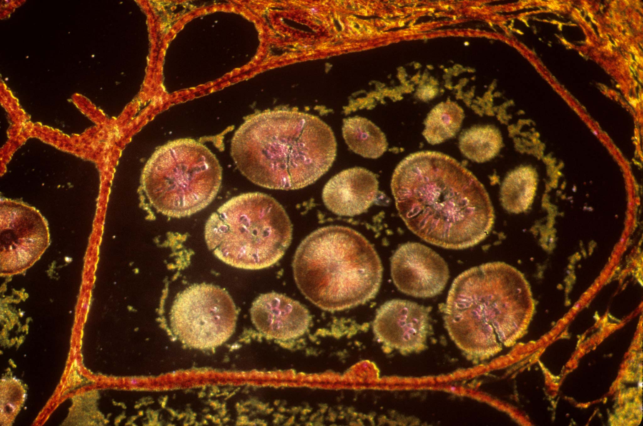 Splendore-Hoeppli Phenomenon in cyst fluid; fibrocystic disease of ...